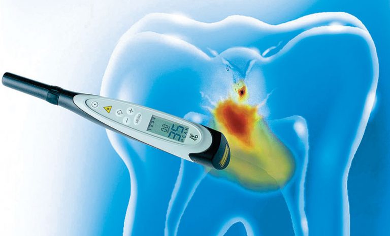 Diagnodent Laser Cavity Detection - Lifetime Smiles